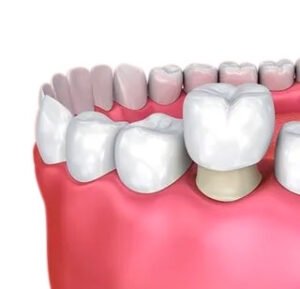 Comprehensive Dental Services | Dental Design Smile in Miami